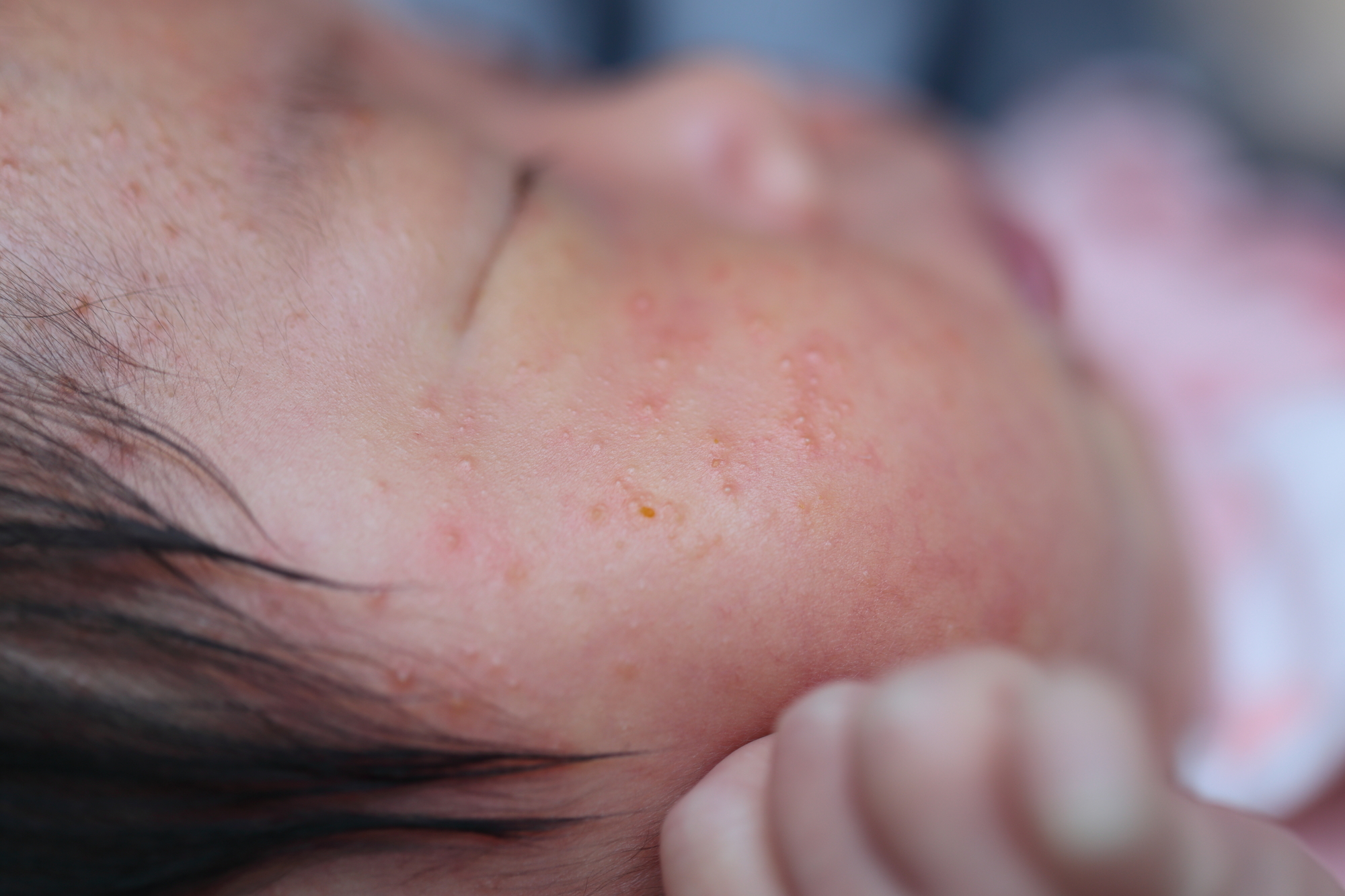 Eczema and atopic dermatitis are more likely to occur in children born ...